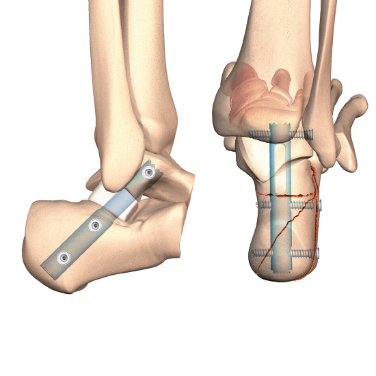 Arthrodèse SubTalaire - Docteur Khelif